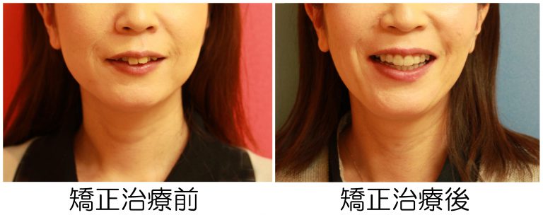 %e6%b2%bb%e7%99%82%e5%89%8d%e5%be%8c%e2%91%a2%e3%82%b9%e3%83%9e%e3%82 ...